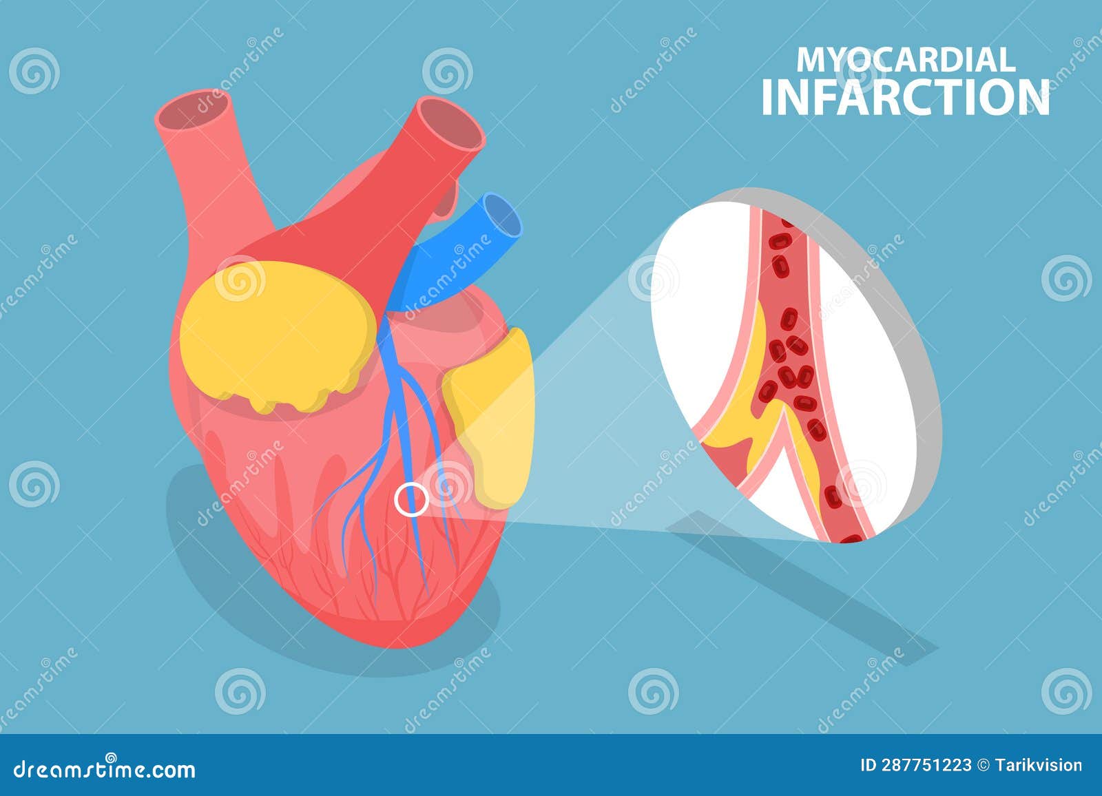 3d Isometric Flat Vector Conceptual Illustration Of Myocardial