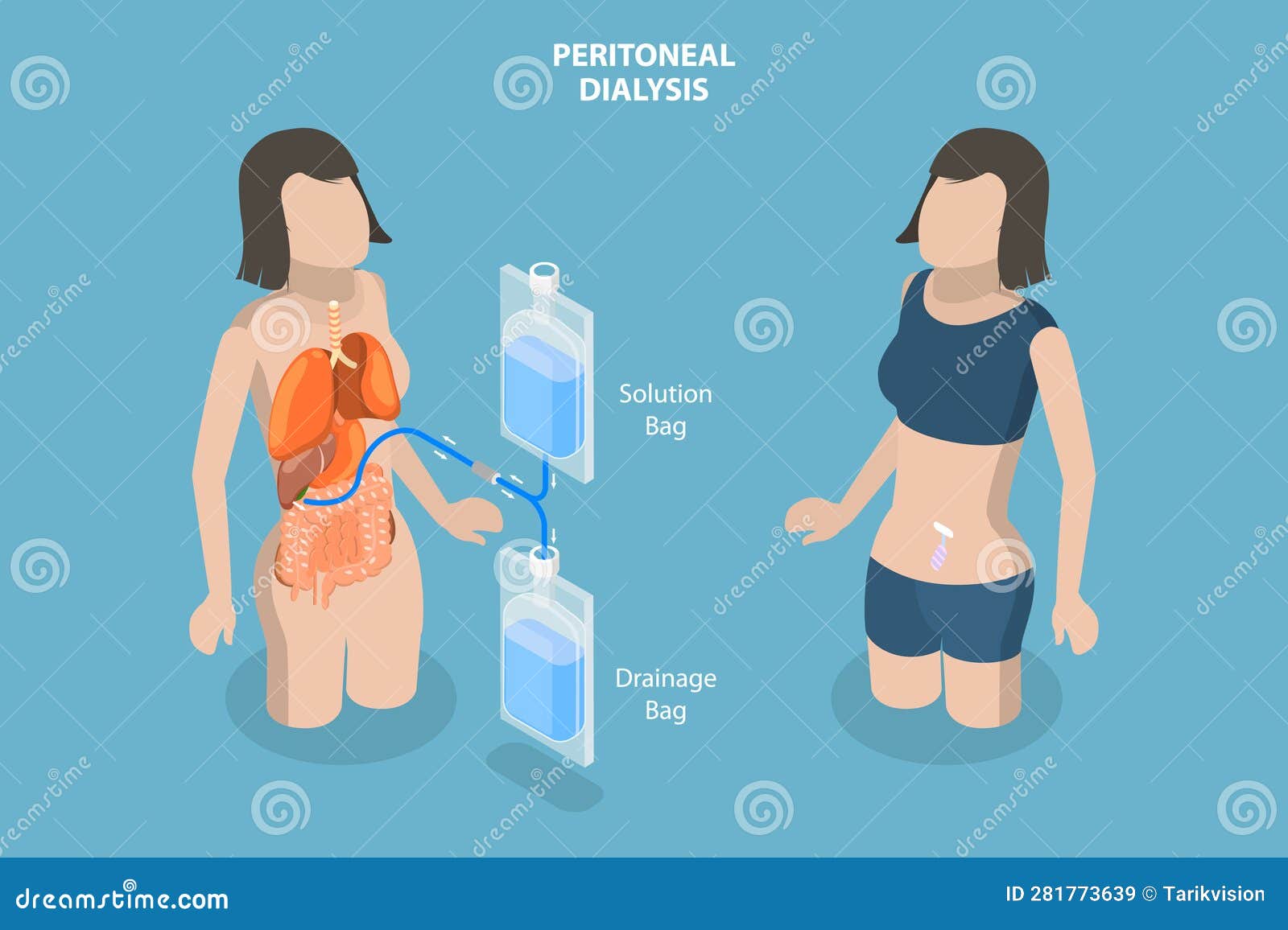 3D Isometric Flat Vector Conceptual Illustration of Peritoneal Dialysis ...