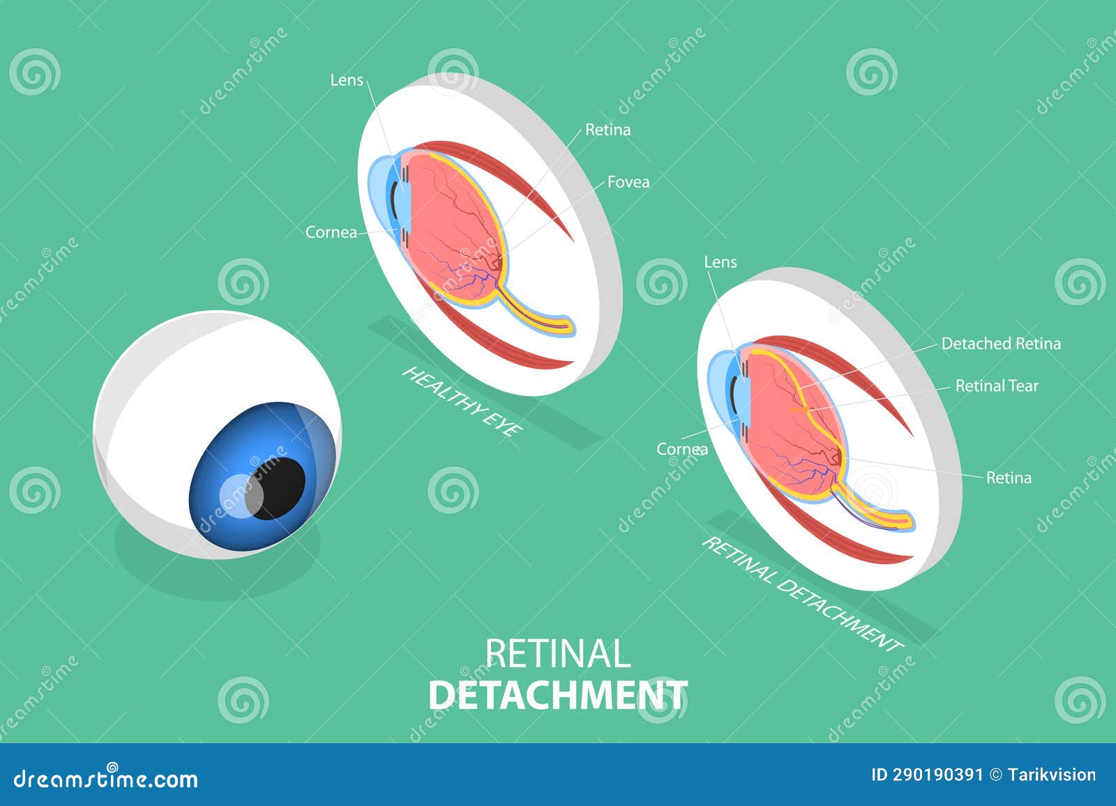 Retinal Detachment Eye Disease Cartoon Vector | CartoonDealer.com ...