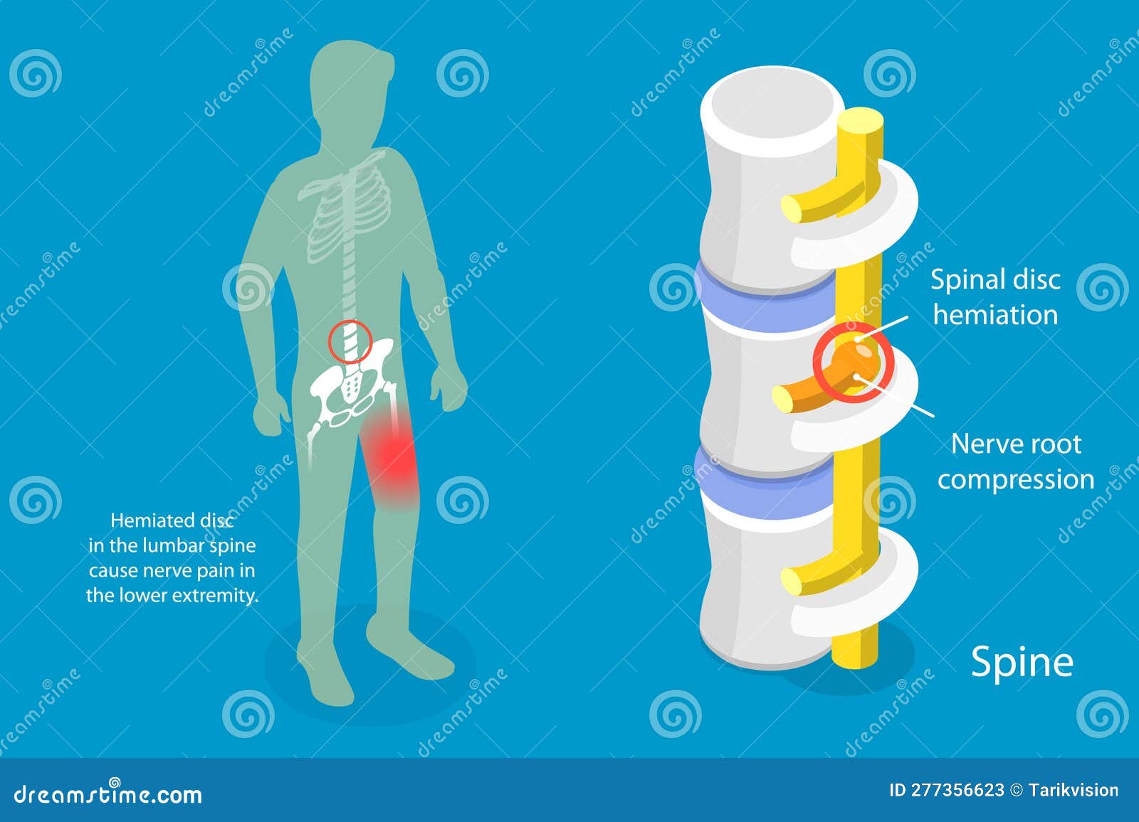 3D Isometric Flat Vector Conceptual Illustration of Sciatica Nerve Pain ...