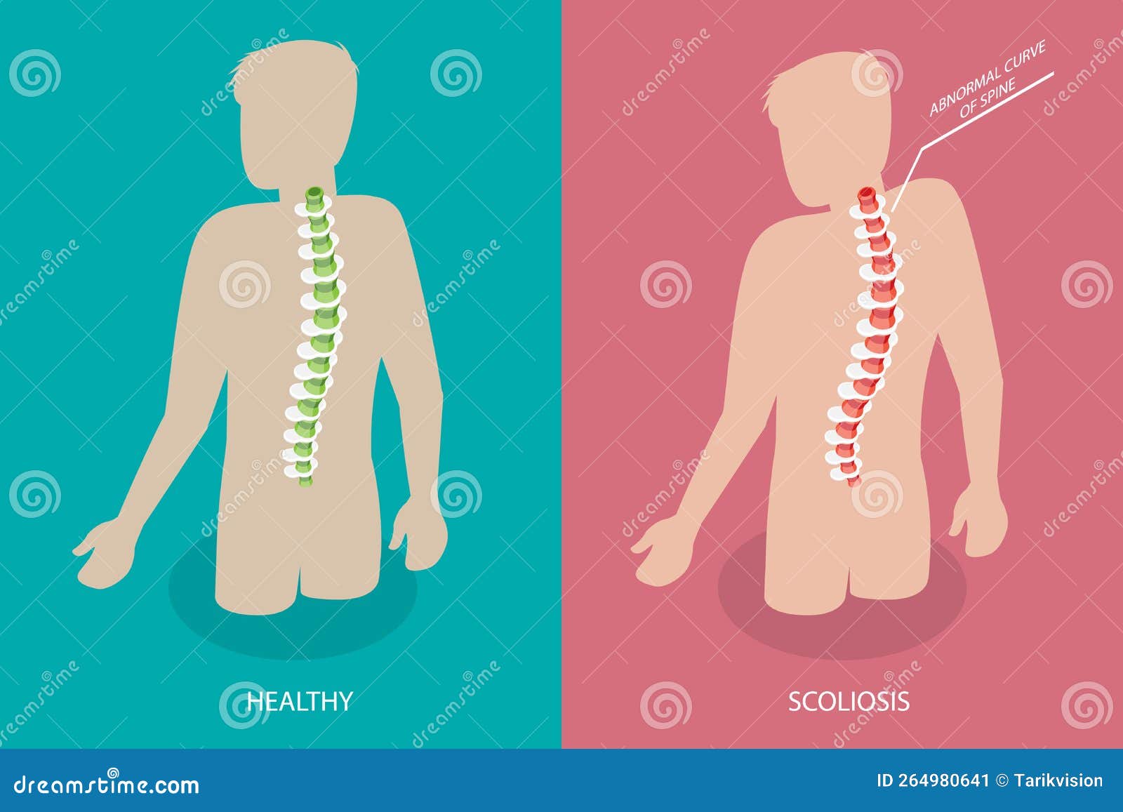 Scoliosis In Children Vector Illustration | CartoonDealer.com #155253264
