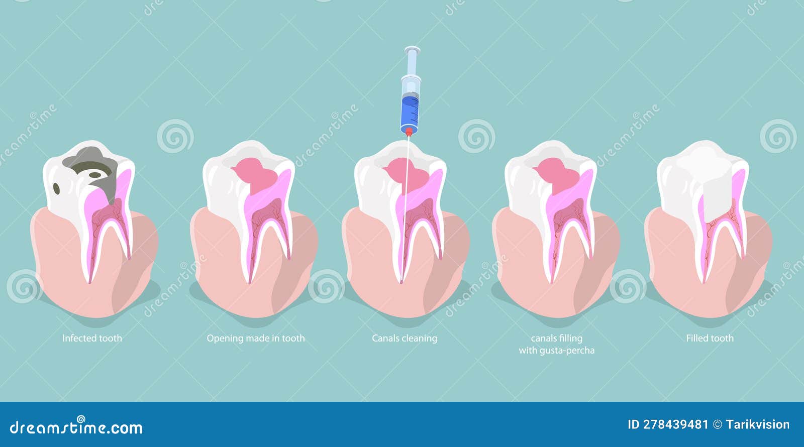3D Isometric Flat Vector Conceptual Illustration of Tooth Decay Stock ...