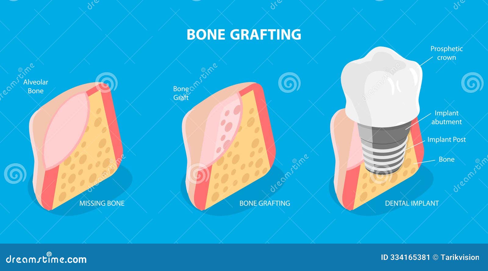 Understanding Bone Resorption The Crucial Role Of Osteoclasts In The ...