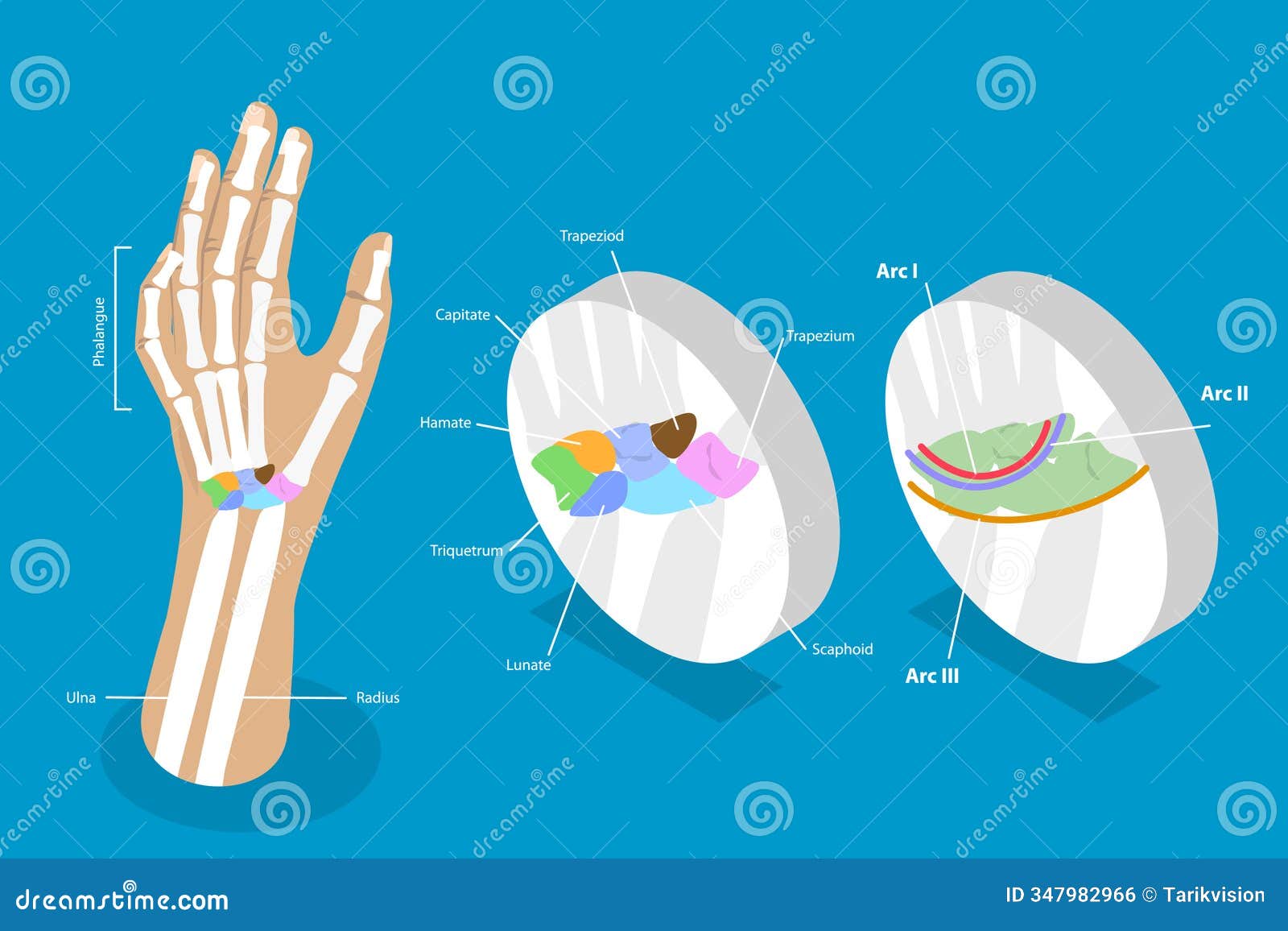 Scaphoid Fracture Diagnosis Wrist XRay Showing A Broken Scaphoid Bone ...