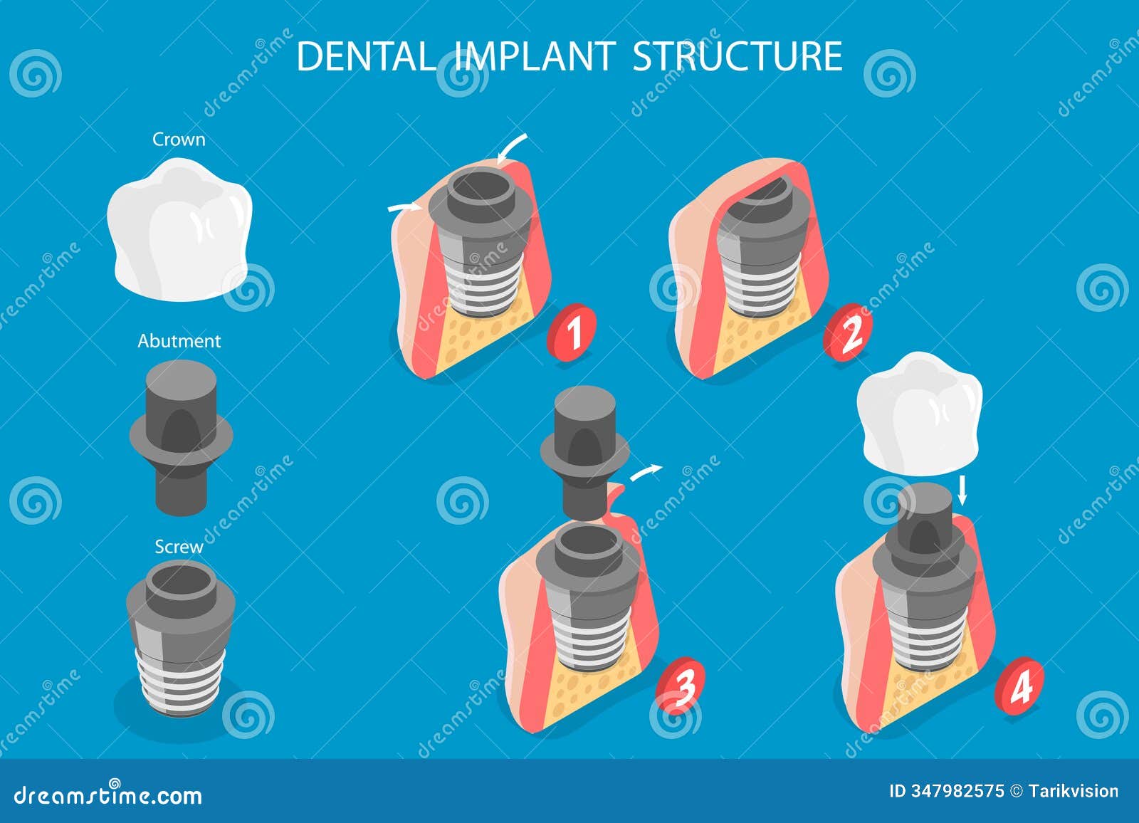 3D Isometric Flat Vector Illustration of Dental Implant Structure Stock ...
