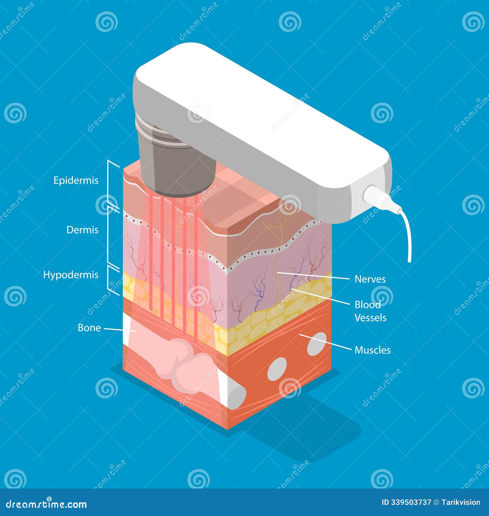 3D Isometric Flat Vector Illustration of Laser Therapy Stock ...