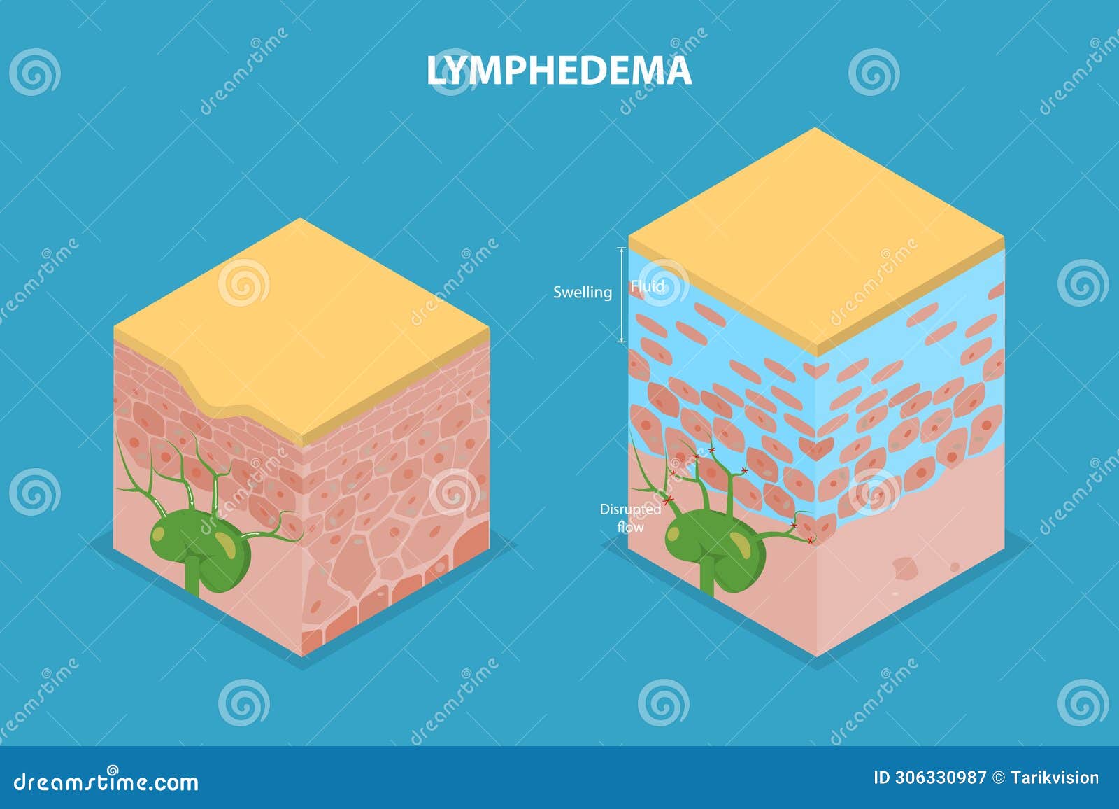 3D Isometric Flat Vector Illustration of Lymphedema Stock Vector ...