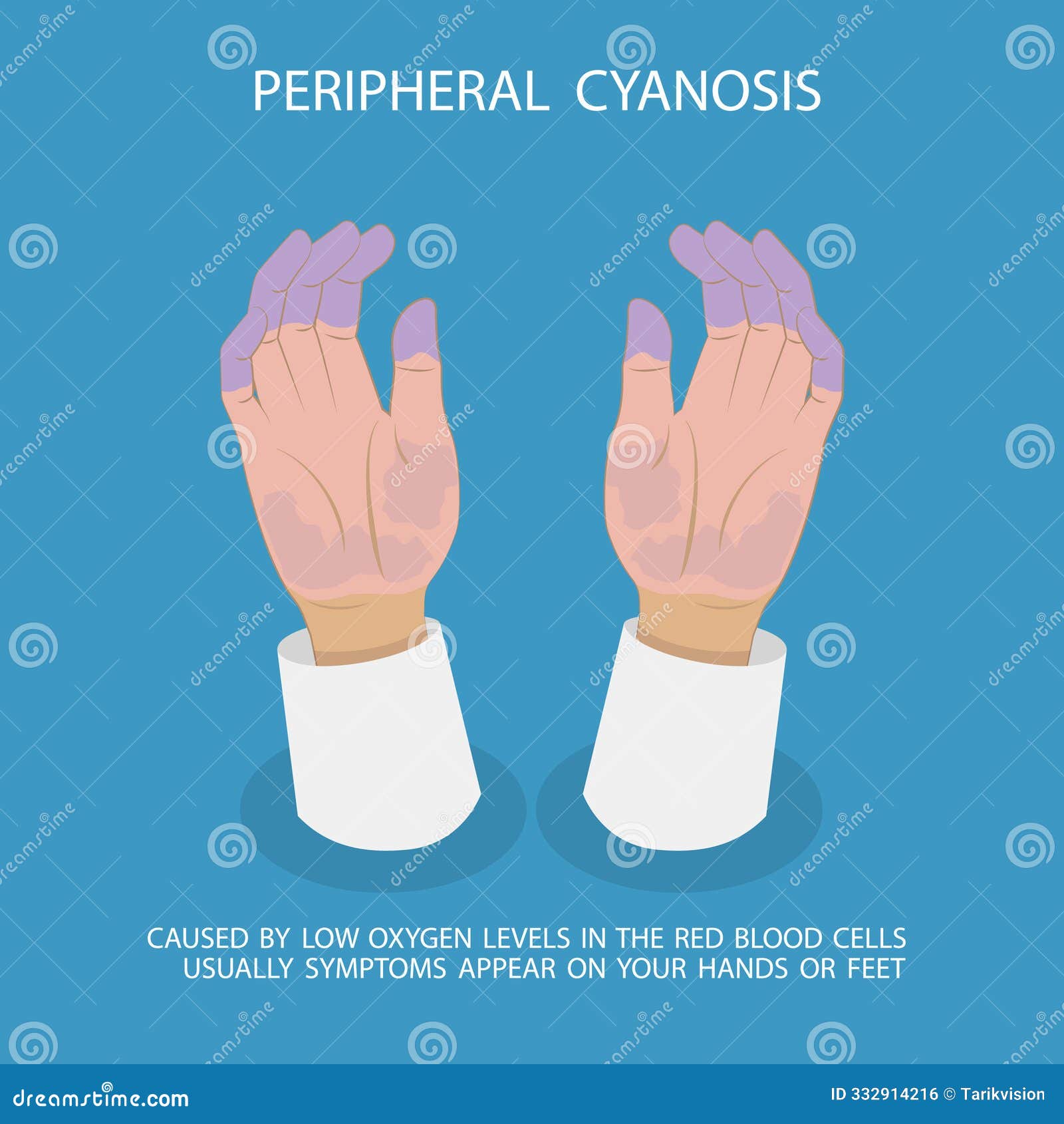 3D Isometric Flat Vector Illustration of Peripheral Cyanosis Symptoms ...