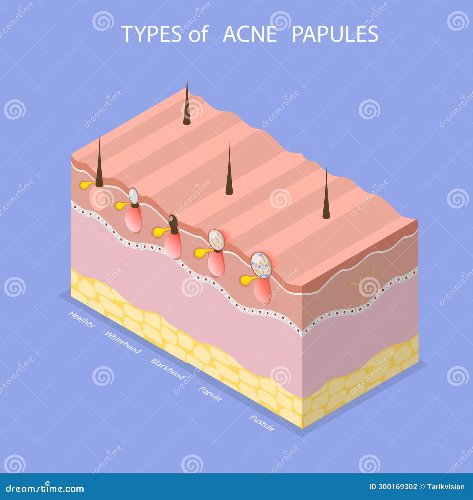 3d Isometric Flat Vector Illustration Of Types Of Acne Papules Stock
