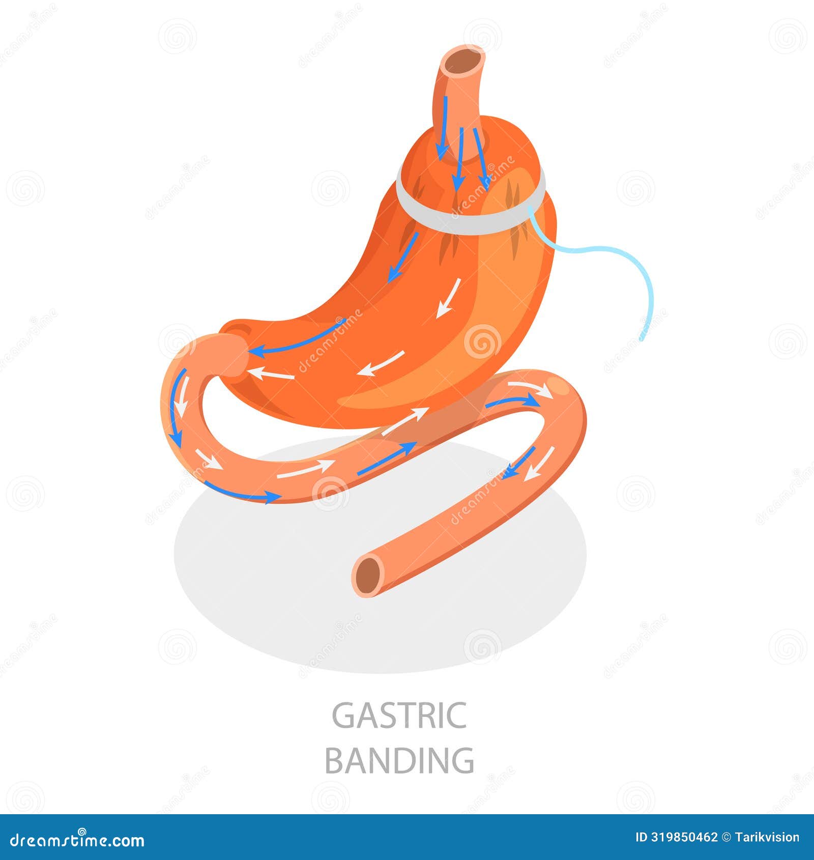 Types Of Bariatric Surgery And Stomach Reduction Control Outline ...