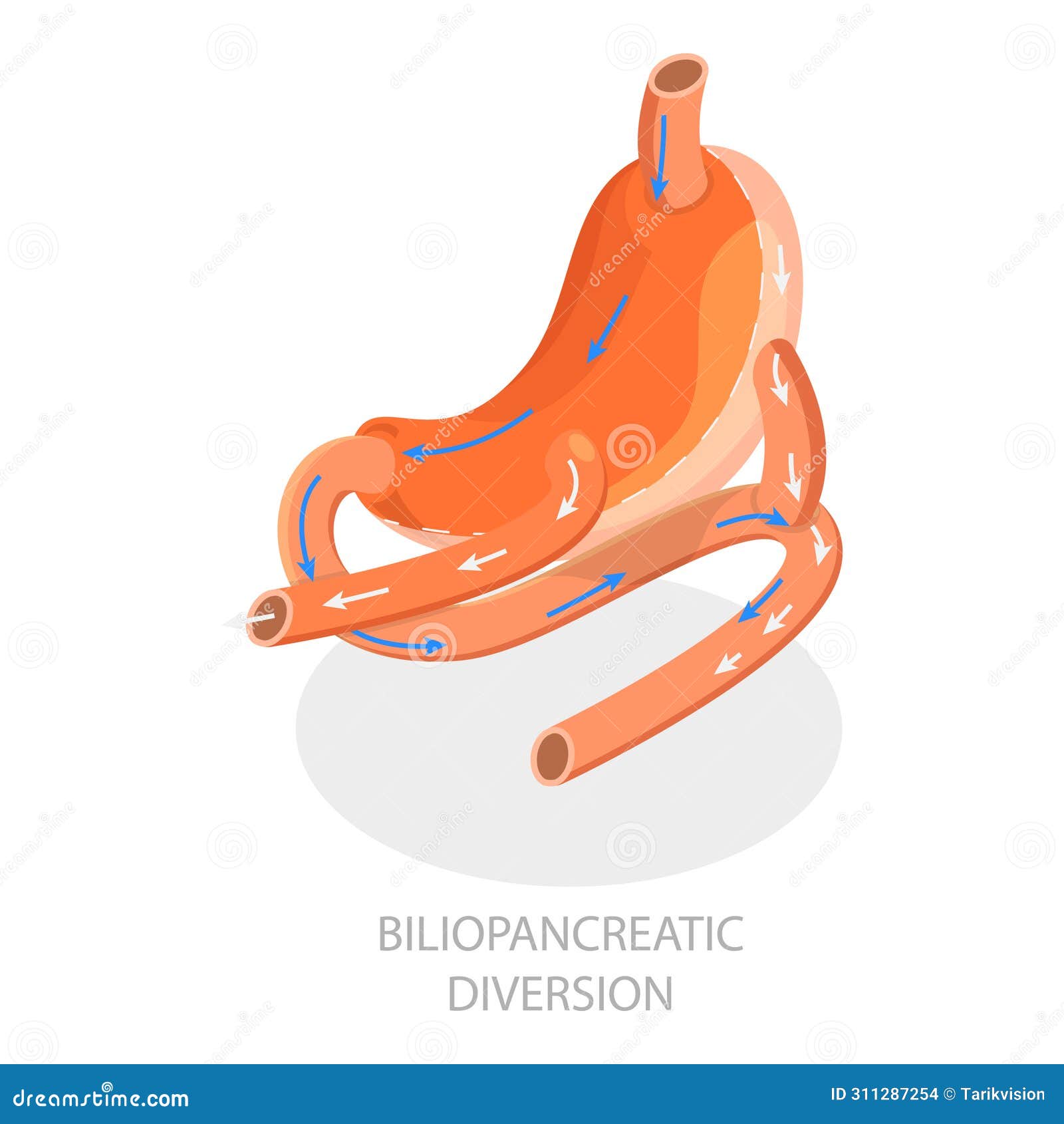 3D Isometric Flat Vector Illustration of Types of Bariatric Surgery ... 3D Isometric Flat Vector Illustration of Types of Bariatric Surgery ...