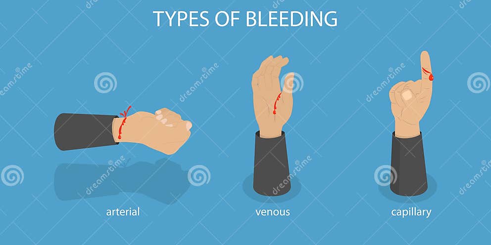 3D Isometric Flat Vector Illustration of Types of Bleeding Stock ...