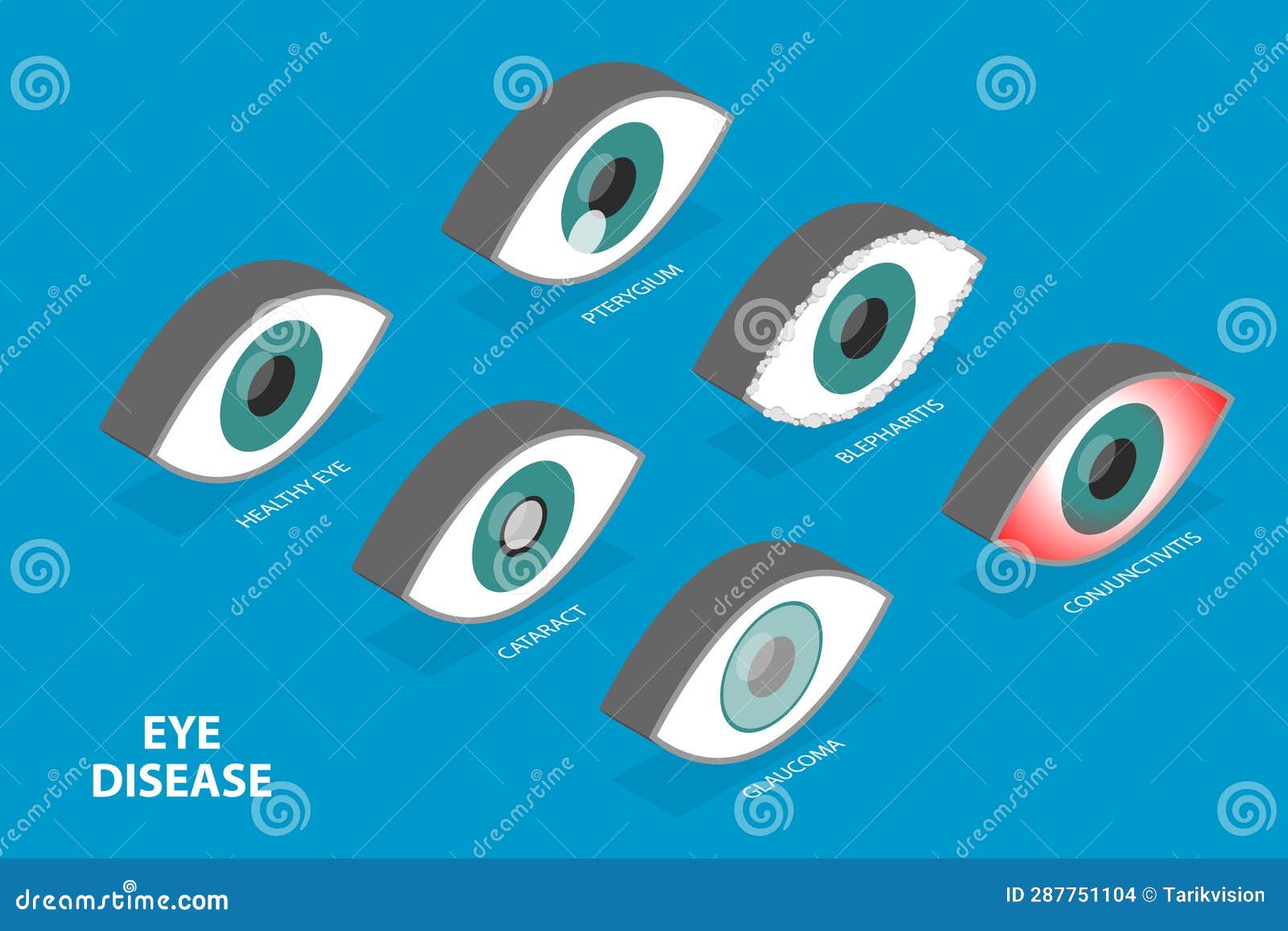3D Isometric Flat Vector Set of Eyes with Different Problems Stock ...