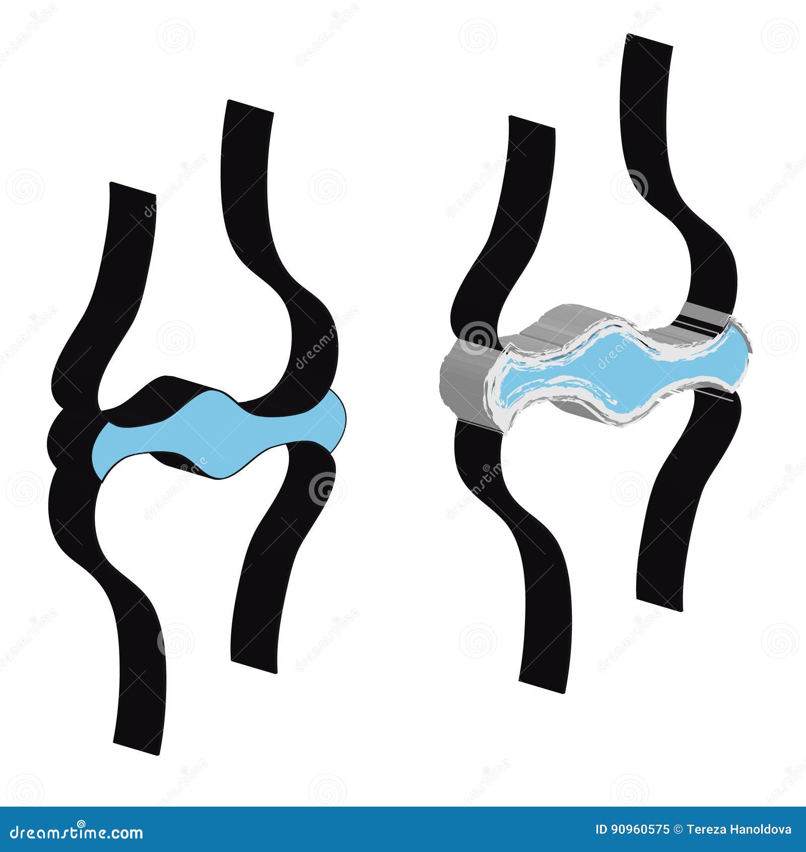 3D Joint with Cartilage and Arthritis Stock Vector - Illustration of ...