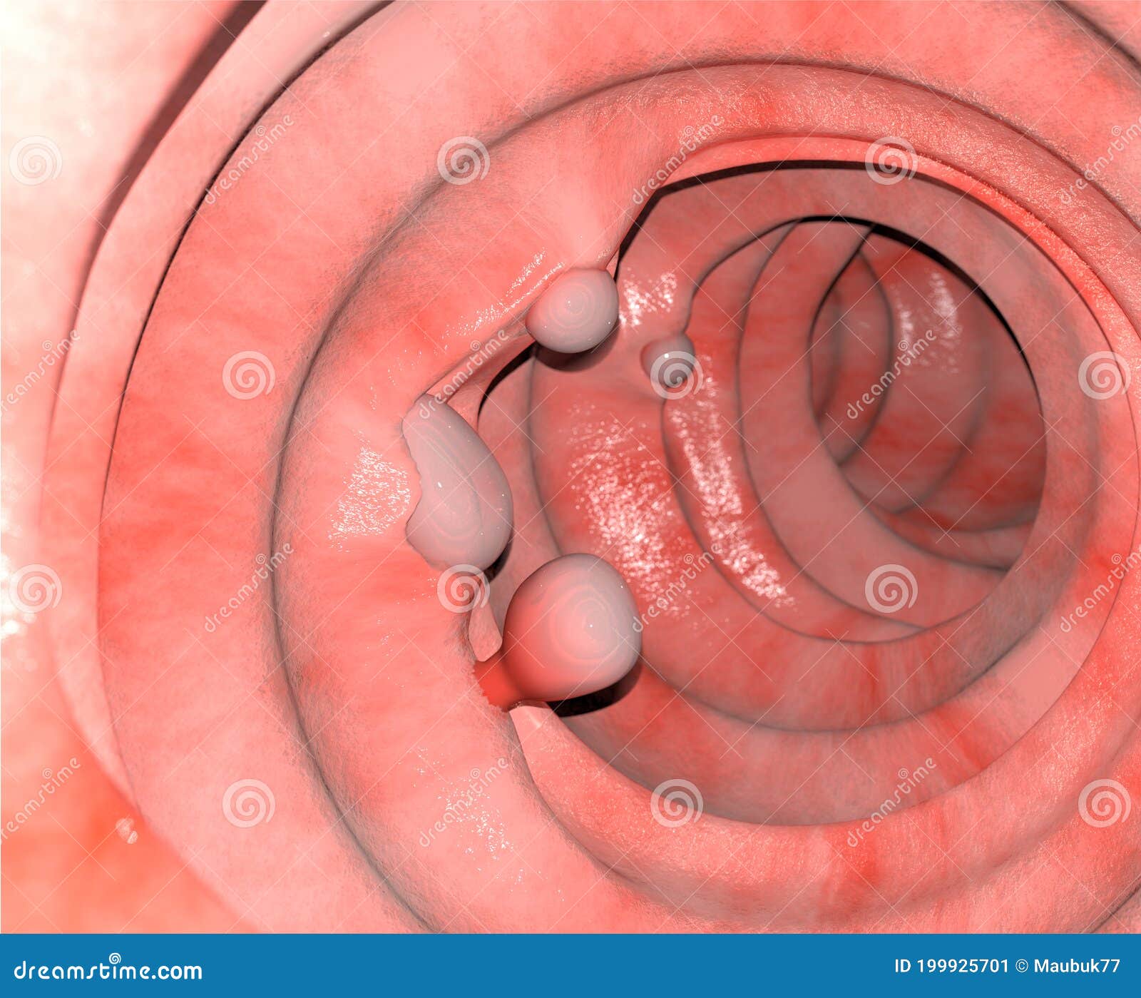 3d Illustration Of The Intestinal Polyps Stock Image | CartoonDealer ...