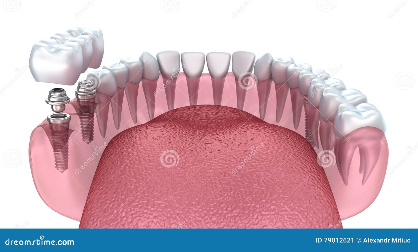 3d Lower Teeth and Dental Implant Transparent Render Stock Illustration ...