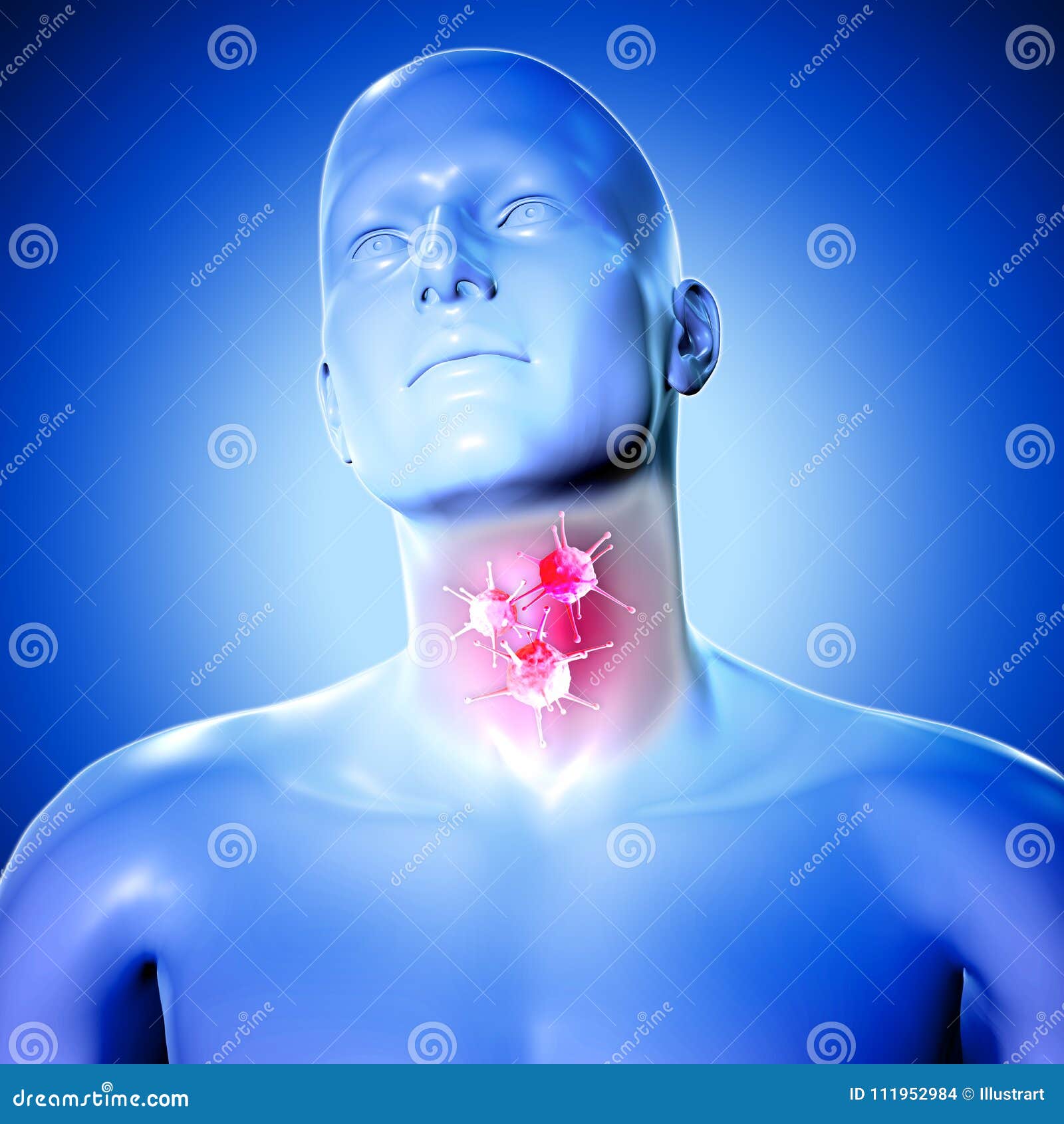 3d Medical Figure with Virus Cells on Sore Throat Stock Illustration ... 3d Medical Figure with Virus Cells on Sore Throat Stock Illustration ...