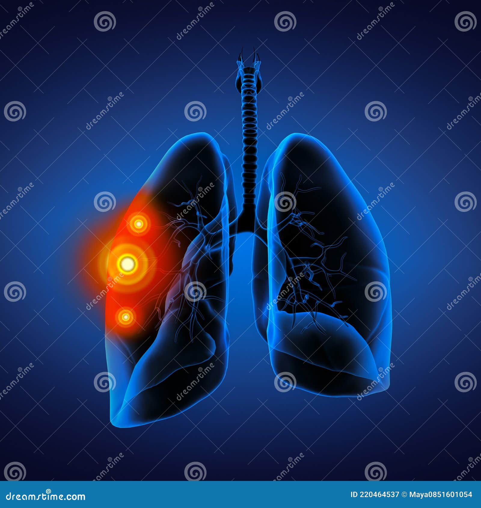 3D Rendering Illustration of Lung Stock Illustration - Illustration of ...