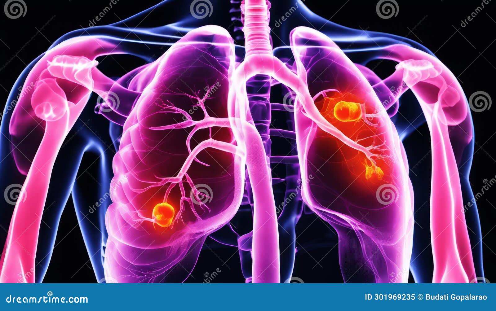A 3D Model of the Human Lungs with Red Spots Stock Illustration ...