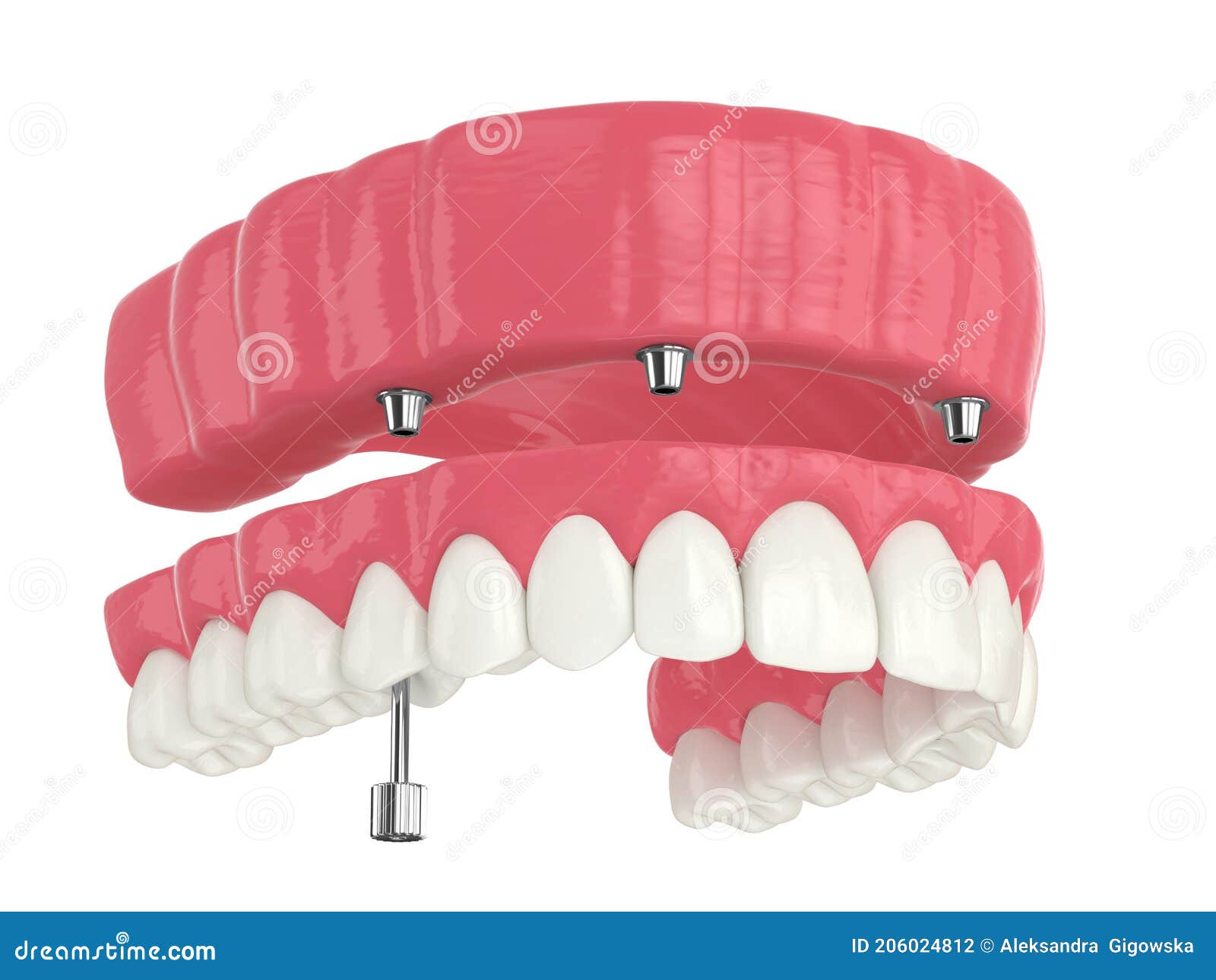 Dental Implants Vector Illustration. Labeled Medical Scheme With Tooth ...