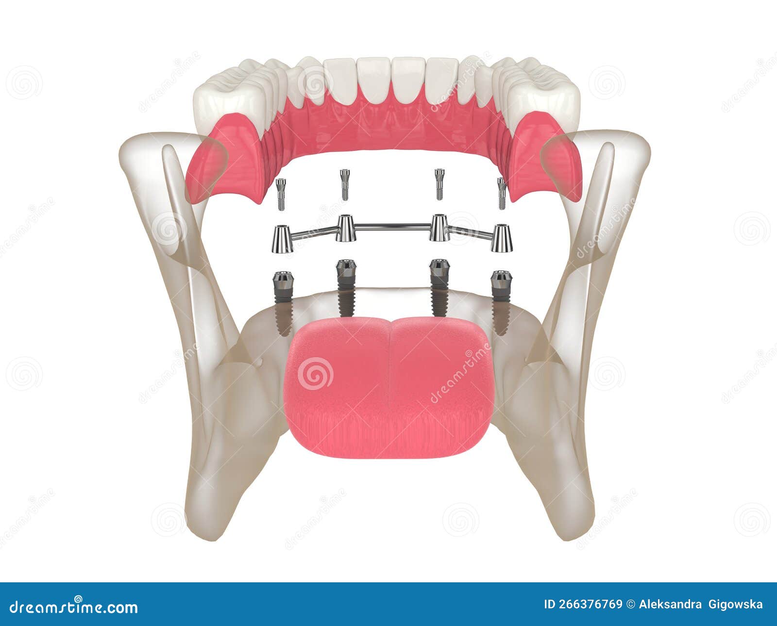 3d Render Of Bar Retained Removable Overdenture Installation Supported ...