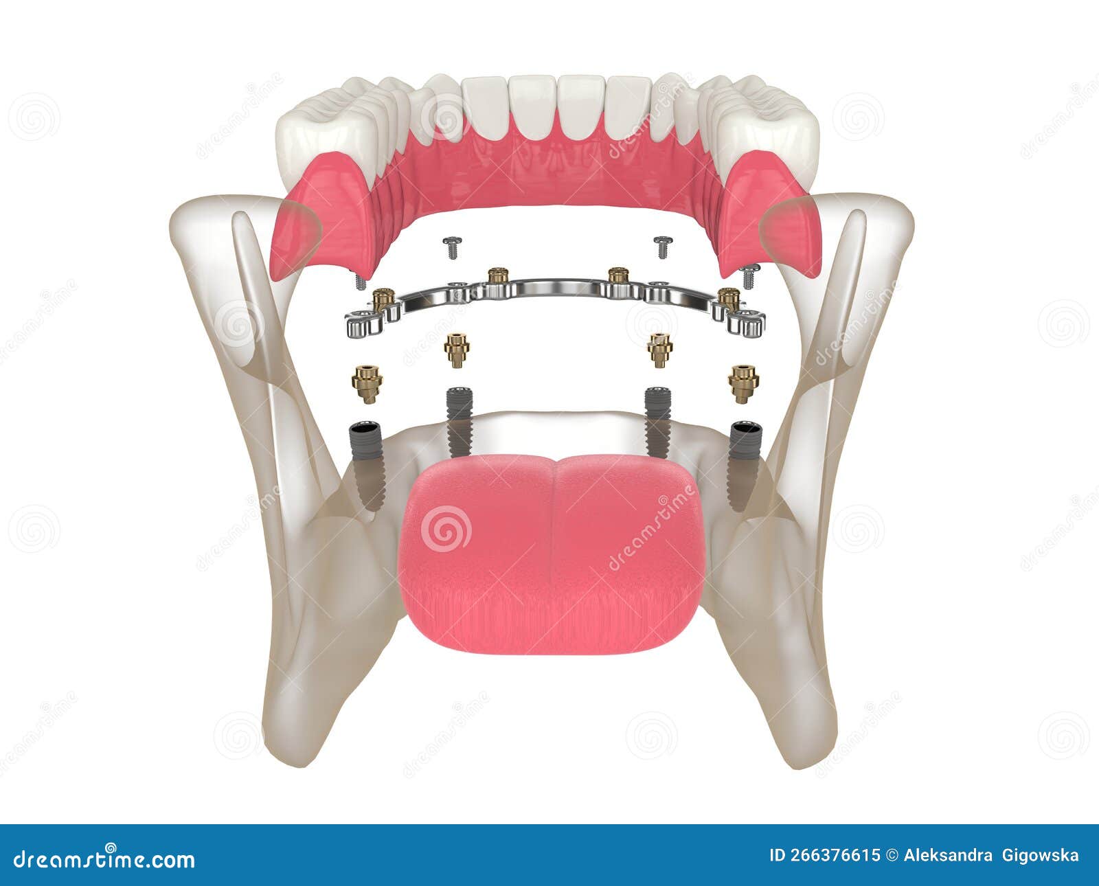 3d Render Of Bar Retained Removable Overdenture Installation Supported ...
