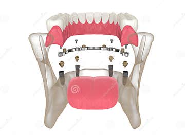 3d Render of Bar Retained Removable Overdenture Installation Supported ...