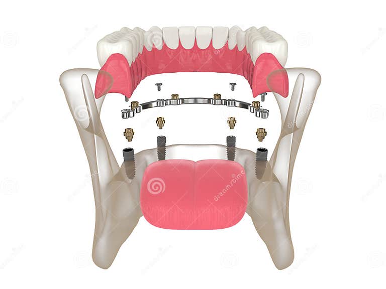 3d Render of Bar Retained Removable Overdenture Installation Supported ...