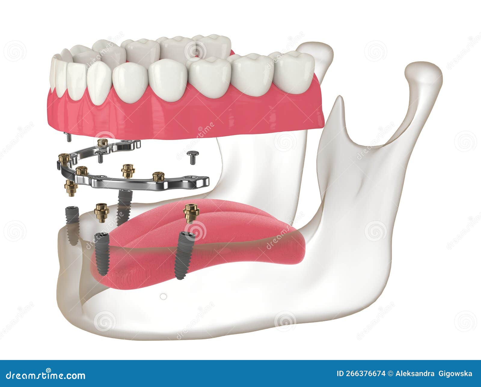3d Render of Bar Retained Removable Overdenture Installation Supported ...