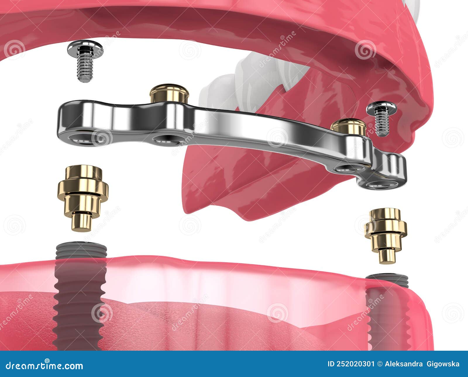 3d Render of Bar Retained Removable Overdenture Installation Supported ...