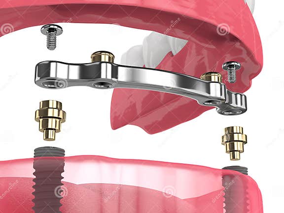 3d Render of Bar Retained Removable Overdenture Installation Supported ...