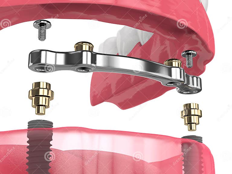 3d Render of Bar Retained Removable Overdenture Installation Supported ...