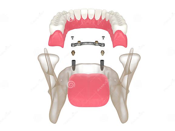 3d Render of Bar Retained Removable Overdenture Installation Supported ...