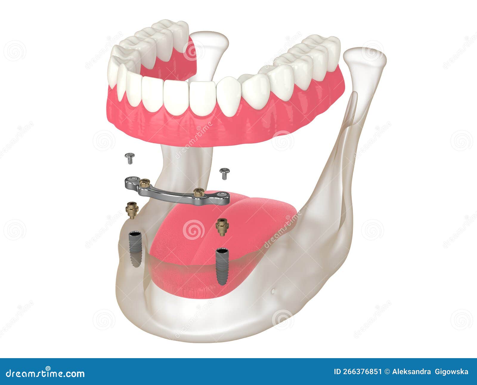 3d Render Of Bar Retained Removable Overdenture Installation Supported ...