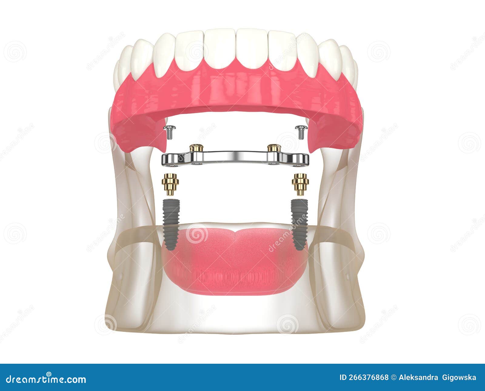 3d Render of Bar Retained Removable Overdenture Installation Supported ...