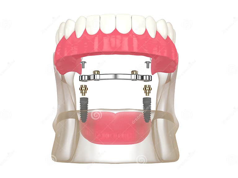 3d Render of Bar Retained Removable Overdenture Installation Supported ...