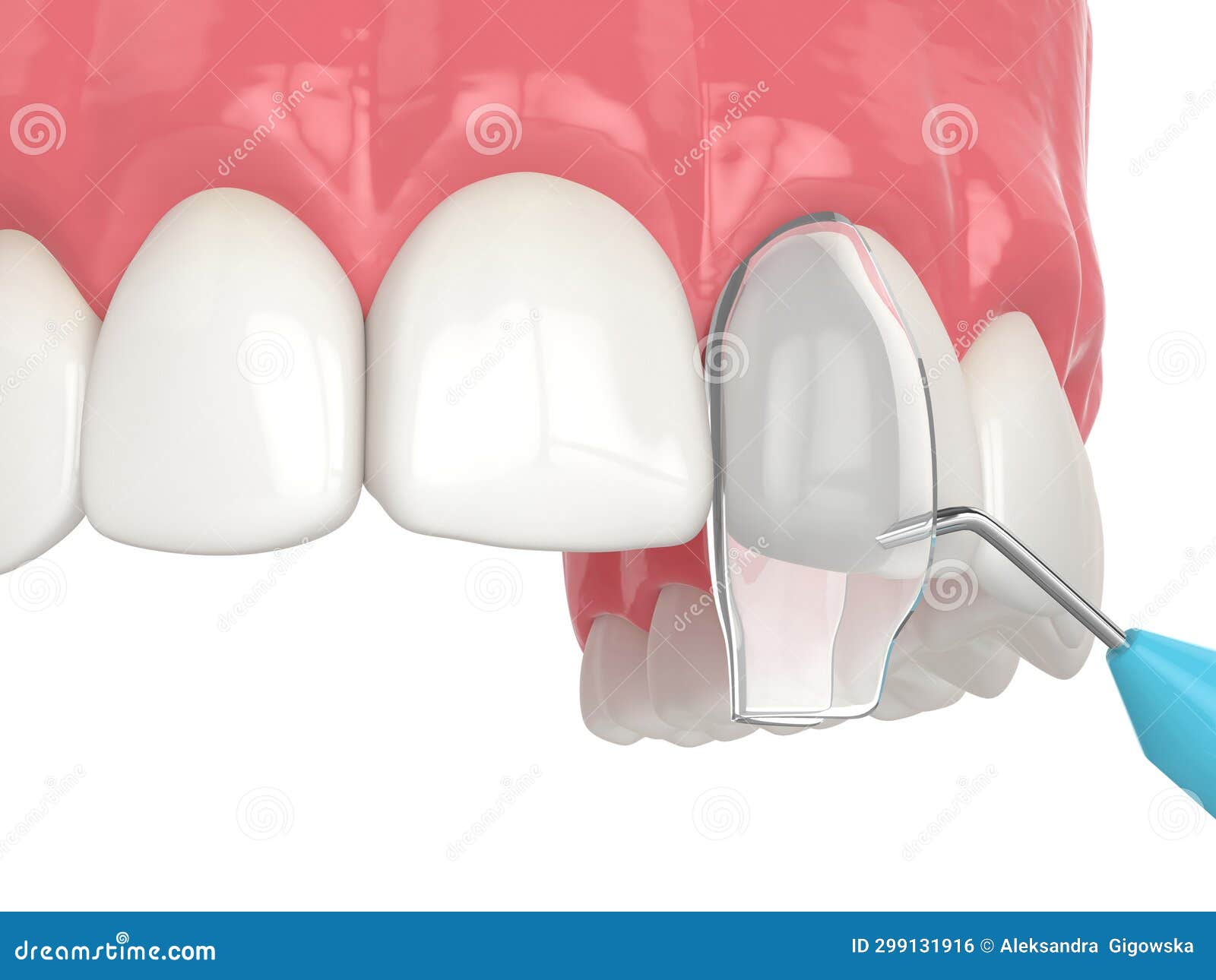 3d Render of Crooked Tooth Treatment Using Bonding Procedure Stock ...