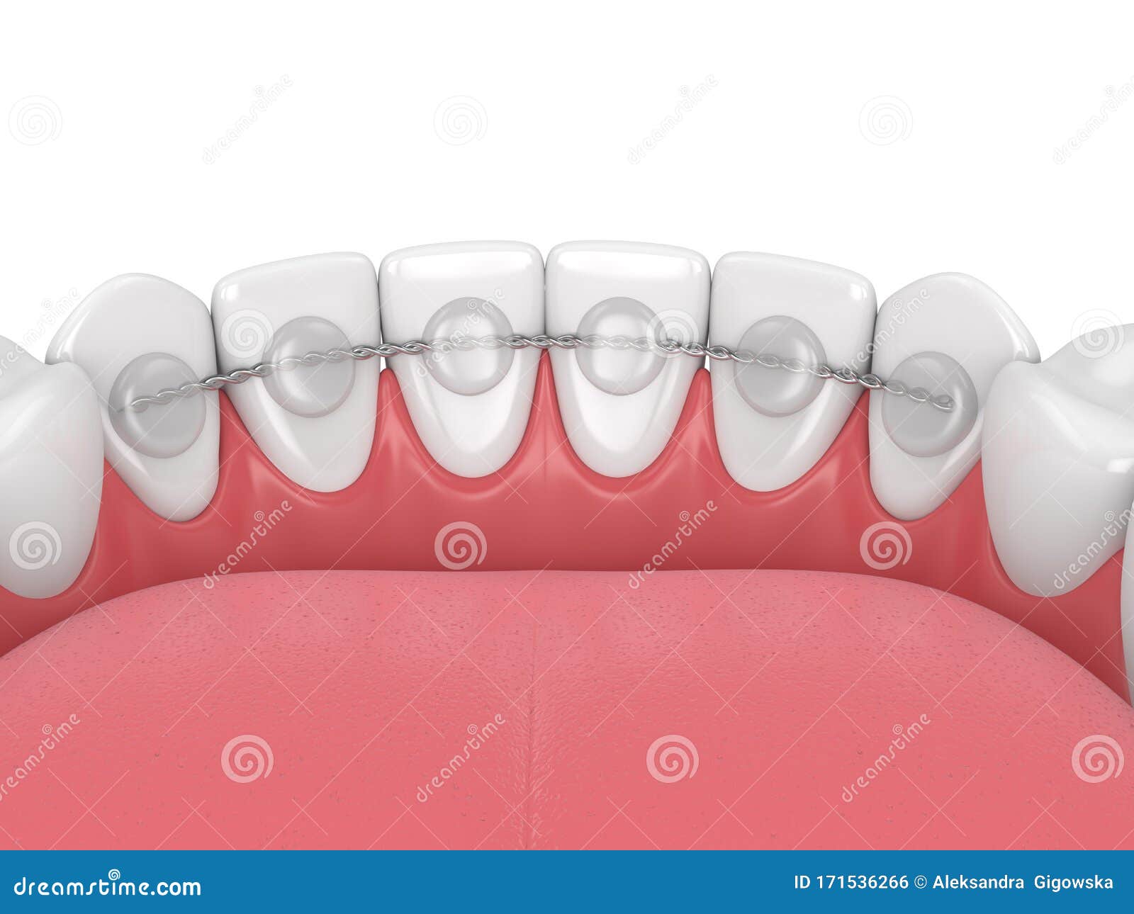 3d Render of Dental Bonded Retainer on Lower Jaw Stock Illustration ...