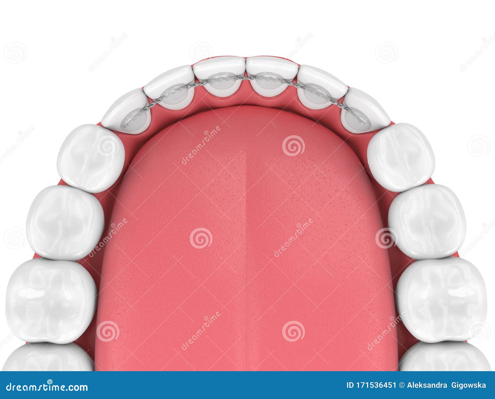 3d Render of Dental Bonded Retainer on Lower Jaw Stock Illustration ...