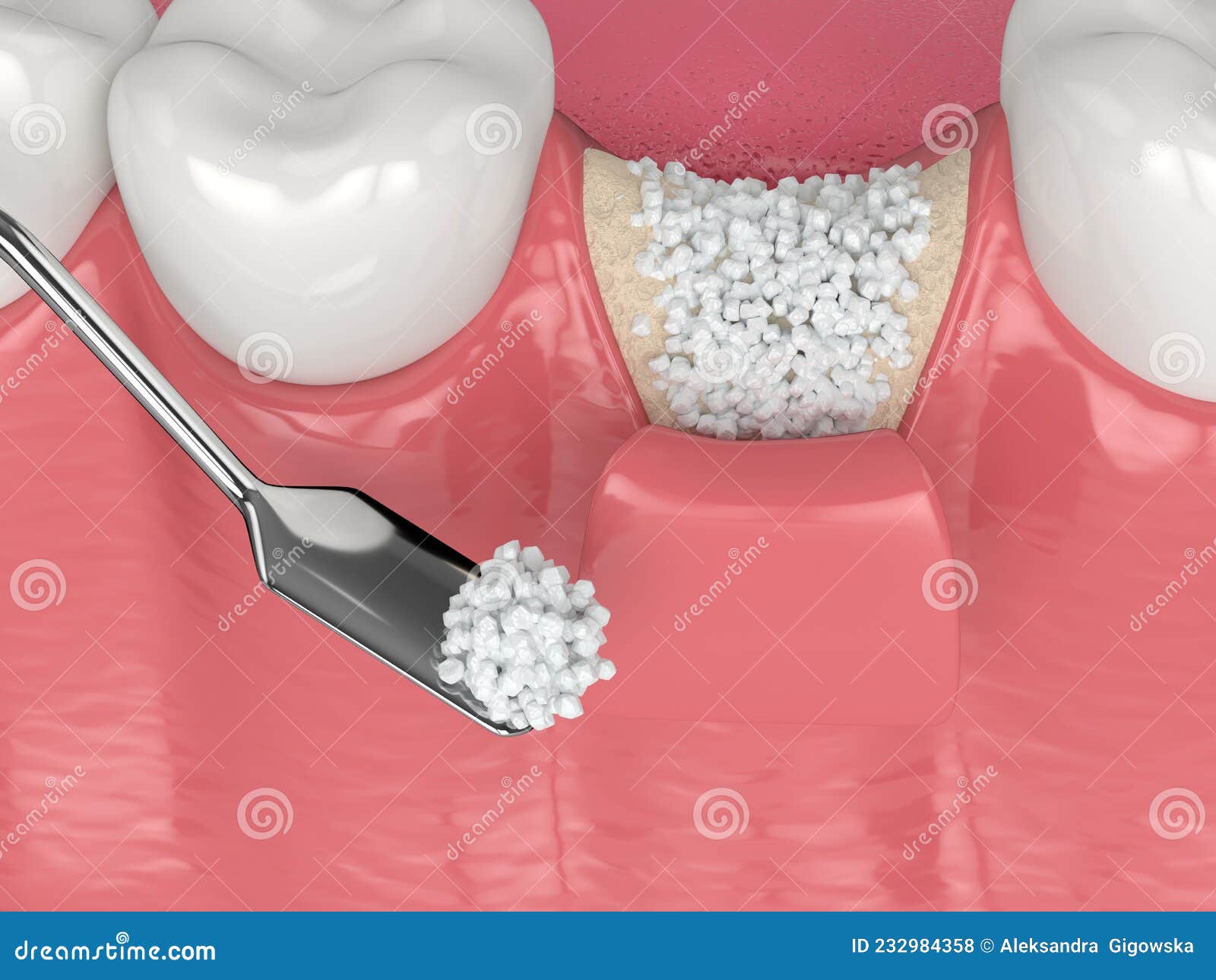 3D Render of Dental Bone Grafting with Bone Biomaterial Application ...