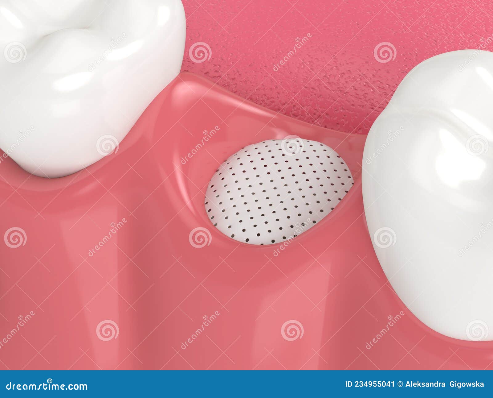 Alveolar Process With Anatomical Head Bone Ridge For Teeth Outline ...