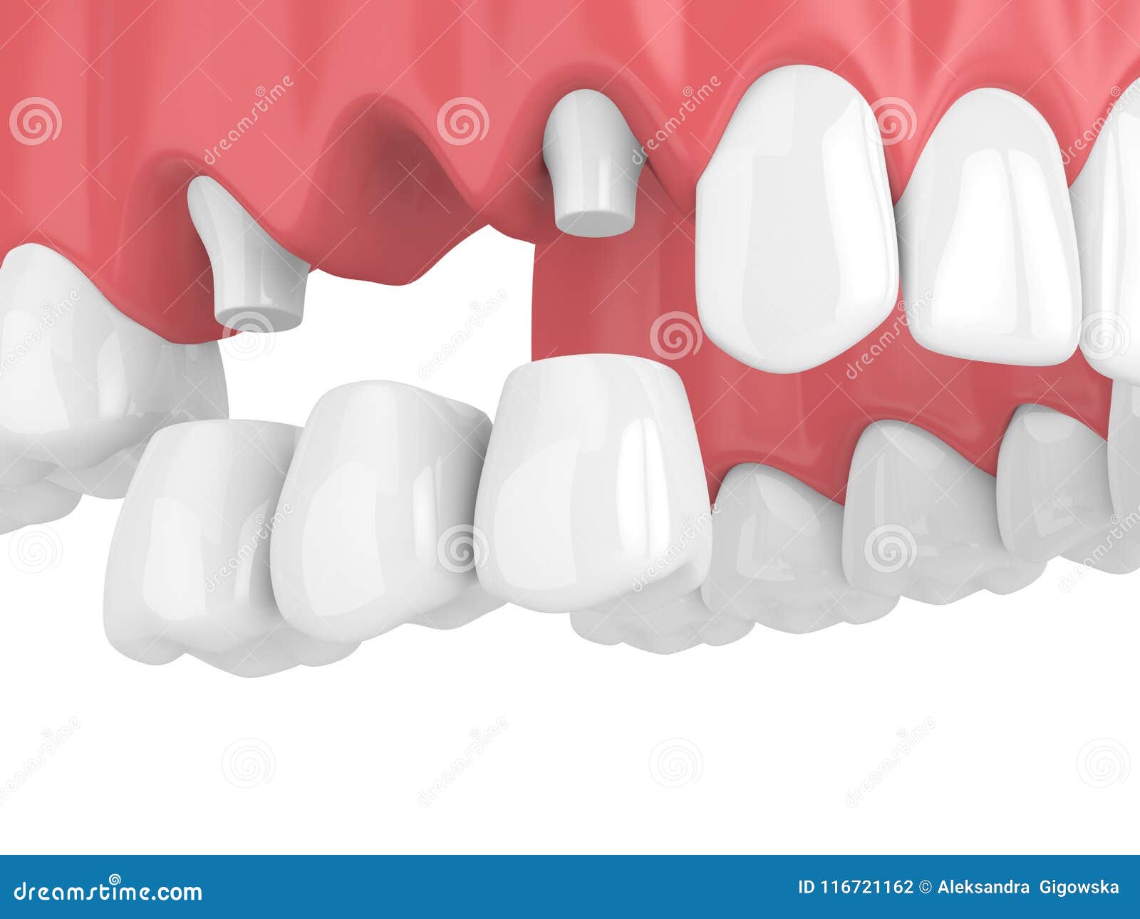 Dental Bridge Concept Vector Educational Poster, Diagram ...