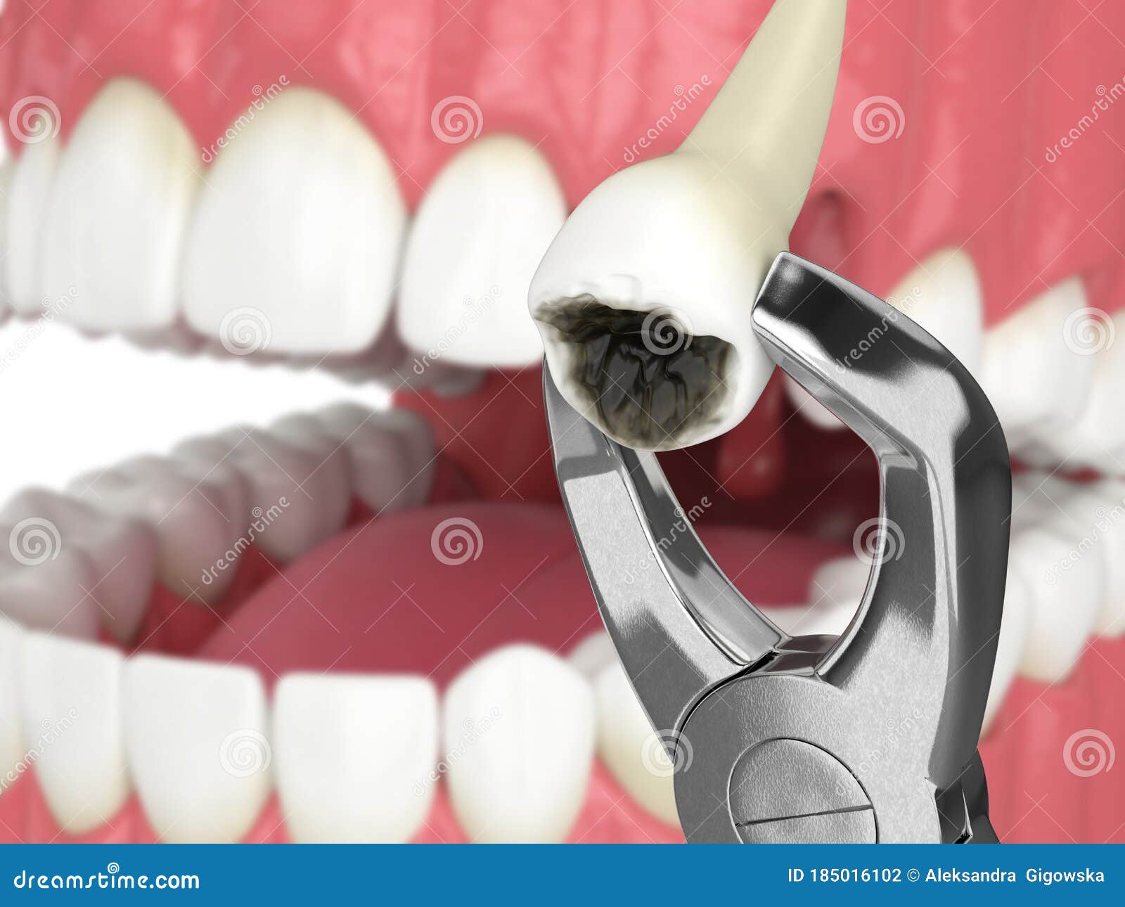 3d Render of Dental Forceps with Extracted Tooth Stock Illustration ...