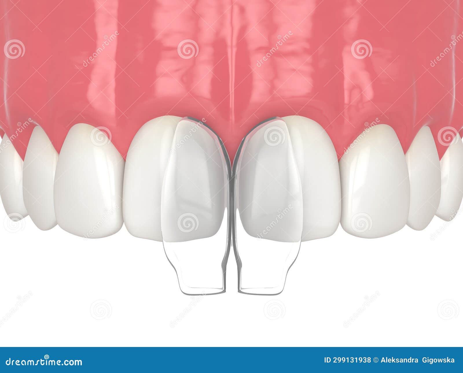 3d Render Of Jaw With Matrix System As A Part Of Bonding Procedure ...