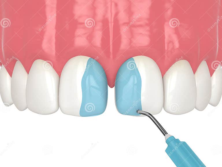 3d Render of Etching the Enamel with a Mild Acid As a Part of Bonding ...