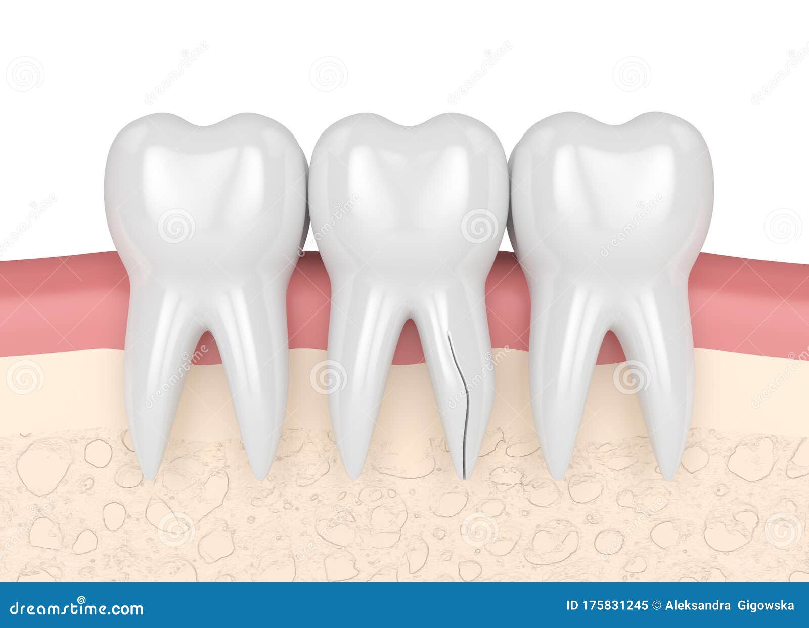 3d Render of Gum with Cracked Tooth Root Stock Illustration ...
