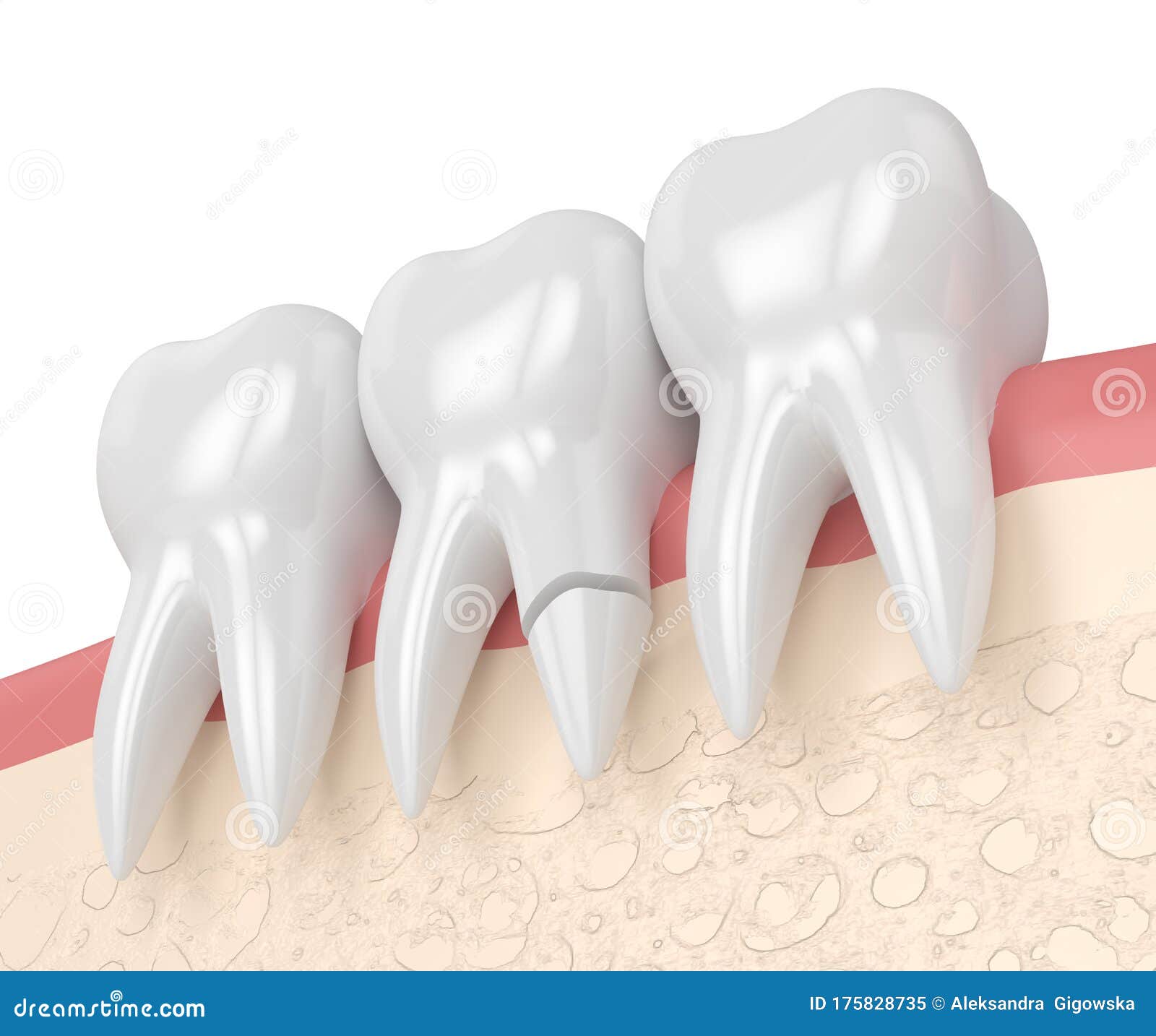 3d Render of Gums with Cracked Tooth Root Stock Illustration ...