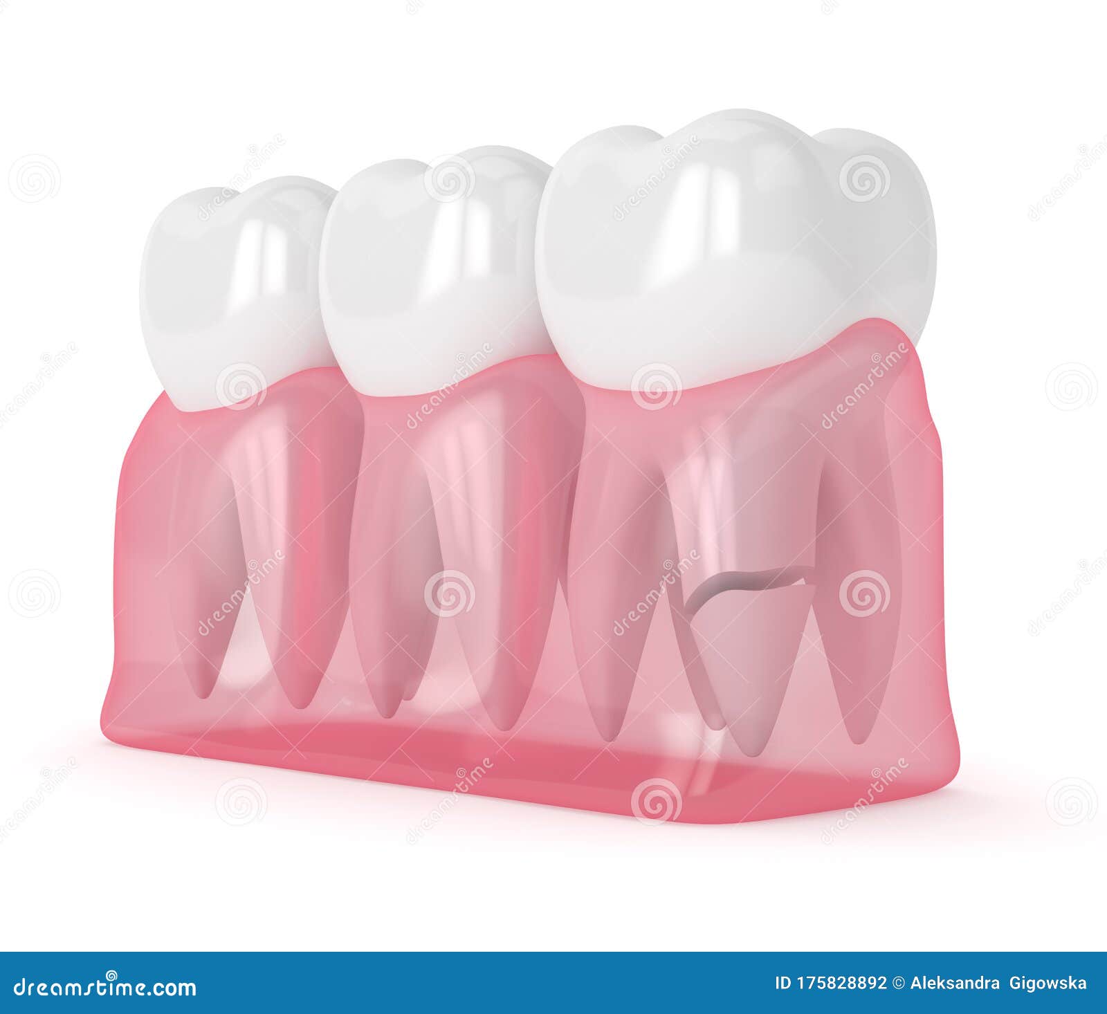 3d Render of Gums with Cracked Tooth Root Stock Illustration ...