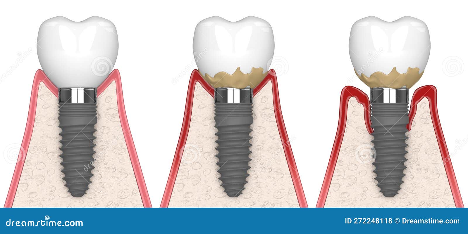 3d Render Of Human Gums Cross-section With Peri Implantitis Disease ...