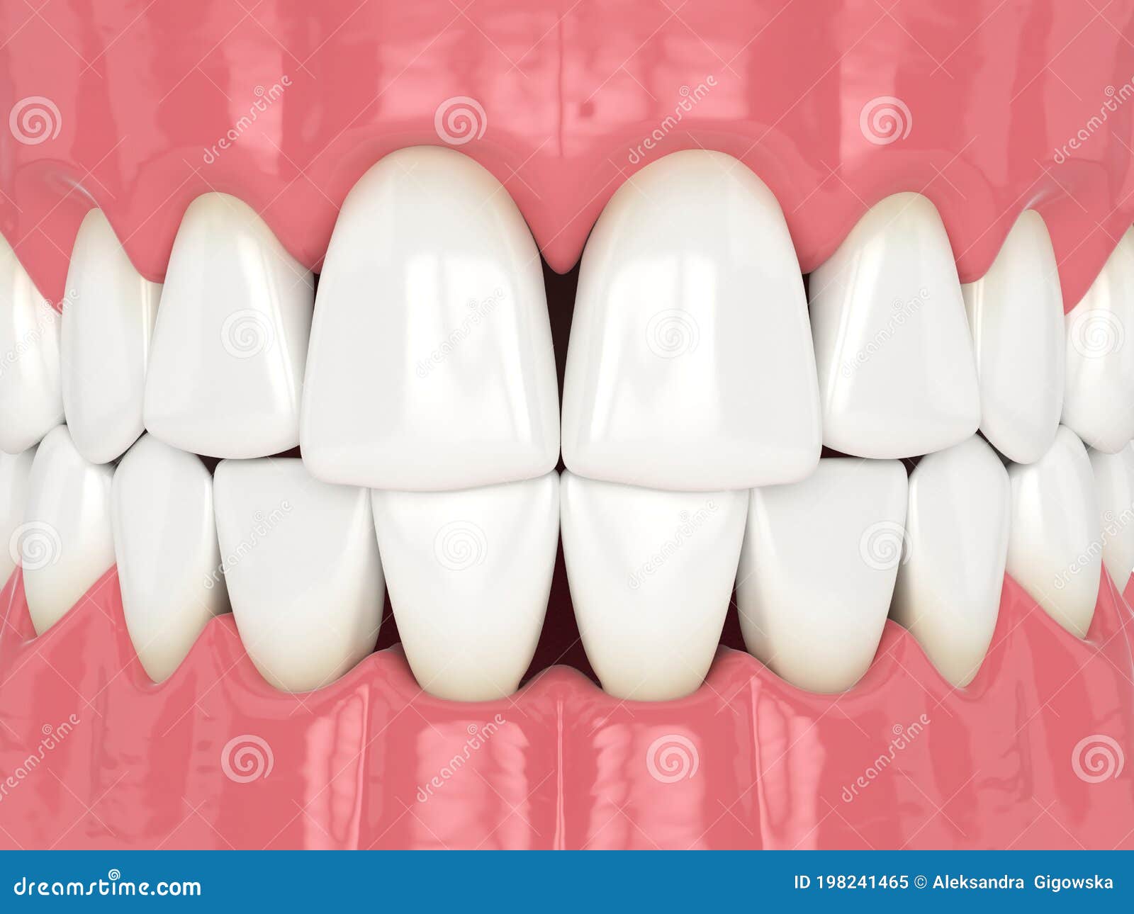 3d Render of Human Jaw with Black Triangles Stock Illustration ...